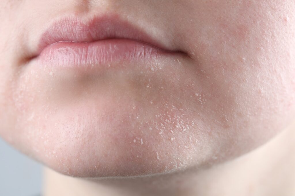 J'ai des squames sur la peau de mon visage : causes et solutions ...